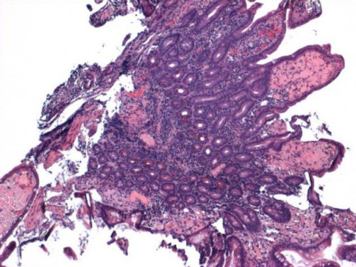 Waldenstrom’s macroglobulinemia (WM) - Lymphoma Australia