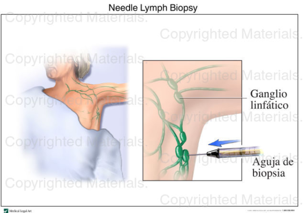 Lymph Node Biopsy Lymphoma Australia