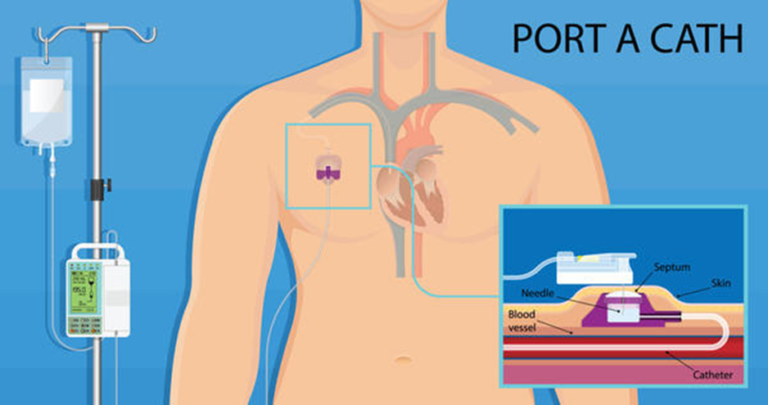 Central venous access devices - Lymphoma Australia