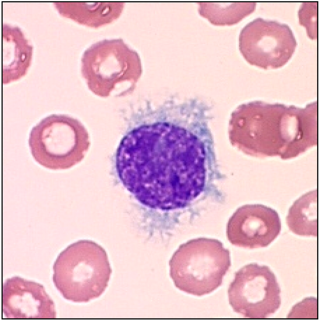 Leukemia Cells